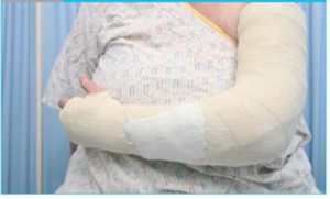 Casts - Macquarie Physiotherapy